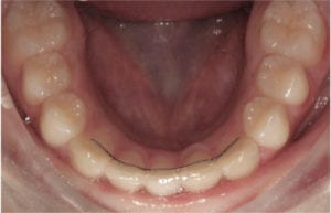 Crowding Of The Teeth | Orthodontics | Specialists In Orthodontics