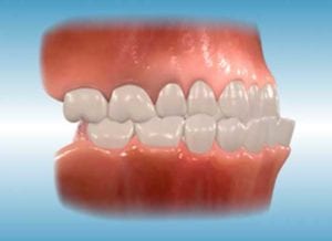 Under Bite | Strong Chin | Orthodontics | Specialists In Orthodontics